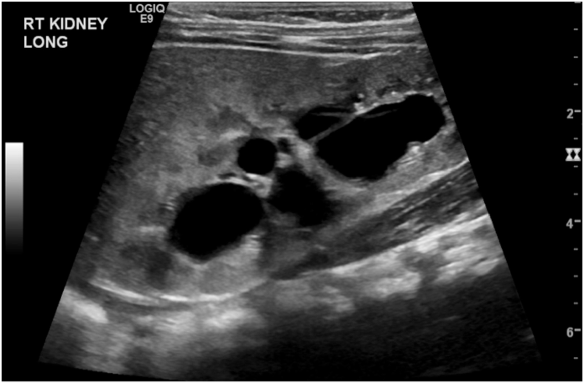 Multicystic dysplastic kidney