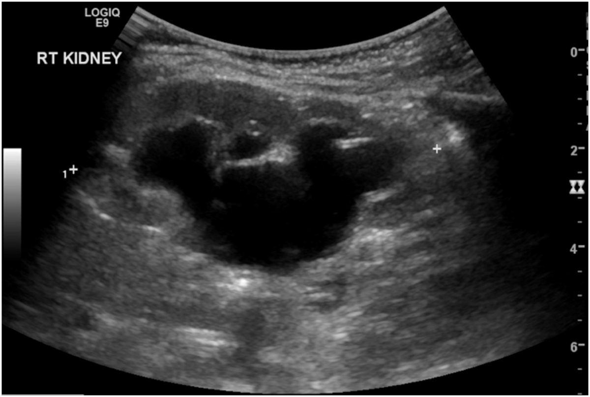 Multicystic dysplastic kidney