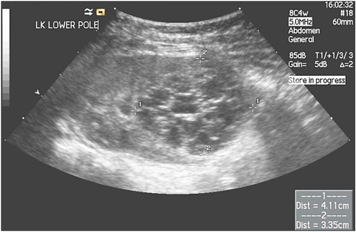 Multicystic dysplastic kidney