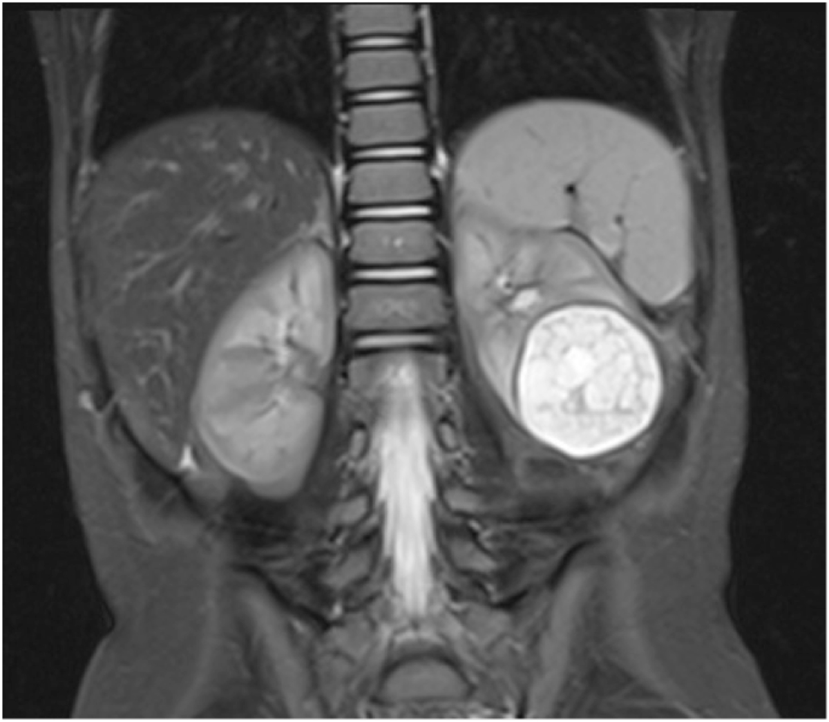 Multicystic dysplastic kidney