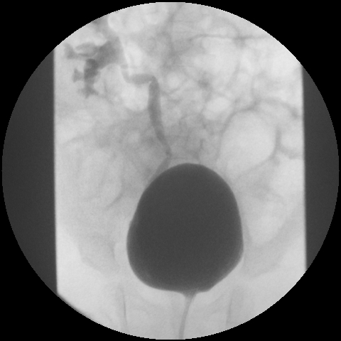 vesicoureteral reflux