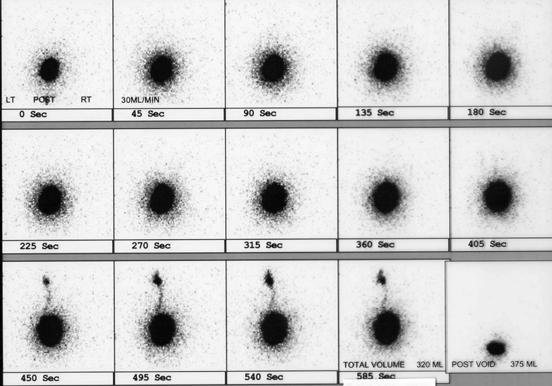 vesicoureteral reflux